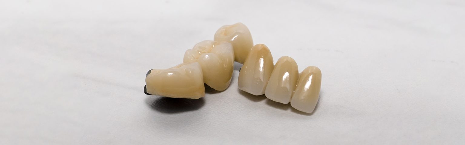 Common Problems with Dental Crowns and How to Fix Them